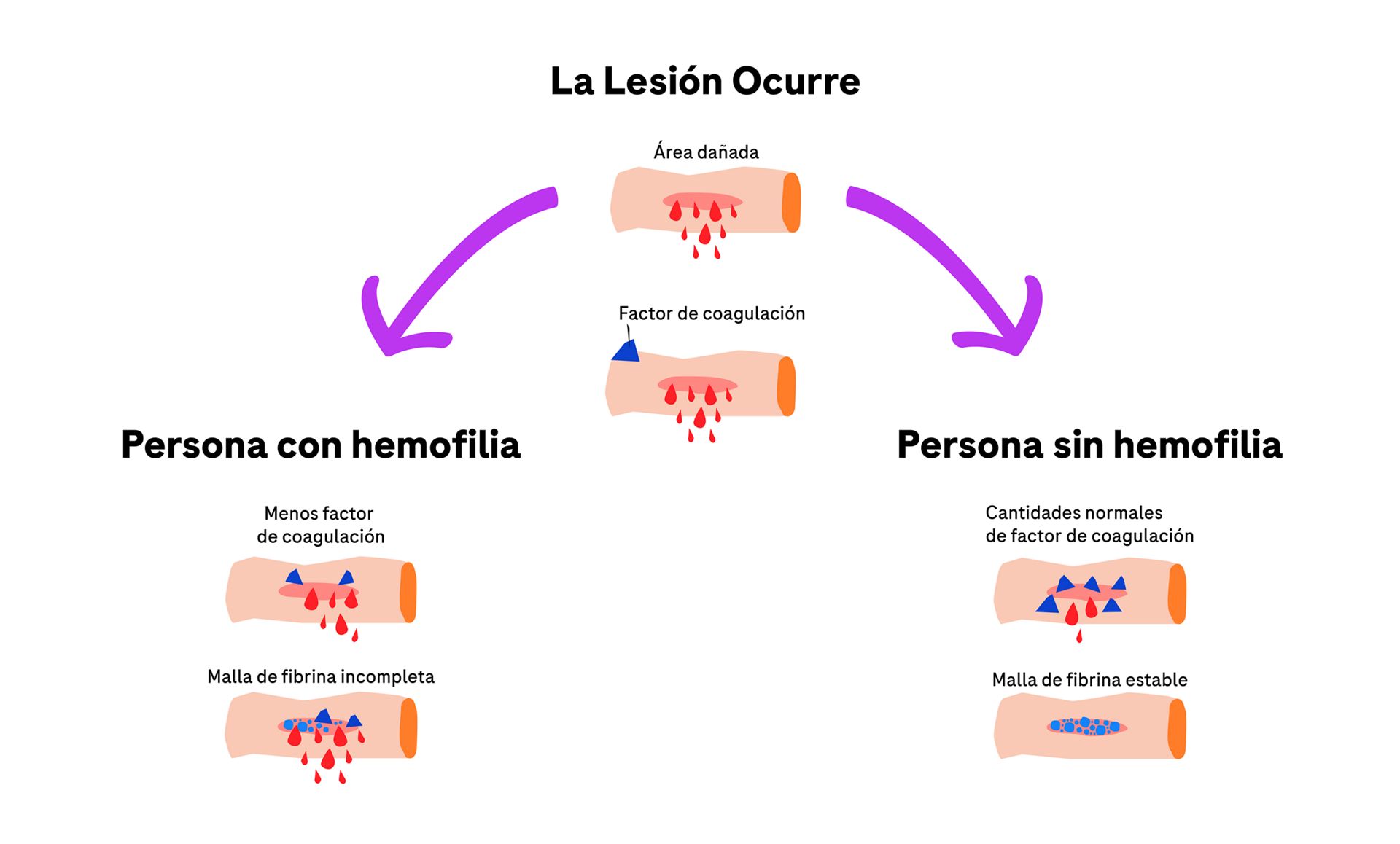 Hemofilia | Roche Contigo