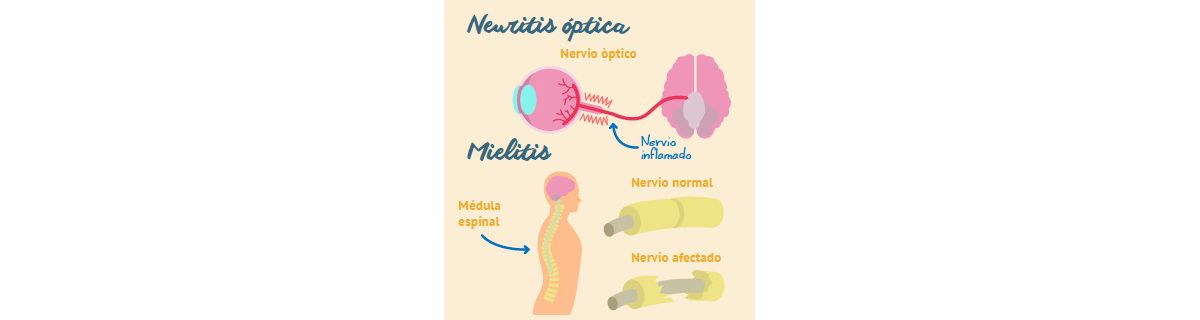 Neuromielitis Óptica | Roche Pacientes