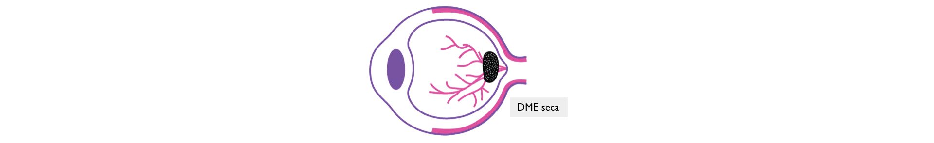 Degeneración Macular Asociada a la Edad (DMAE) | Roche Pacientes