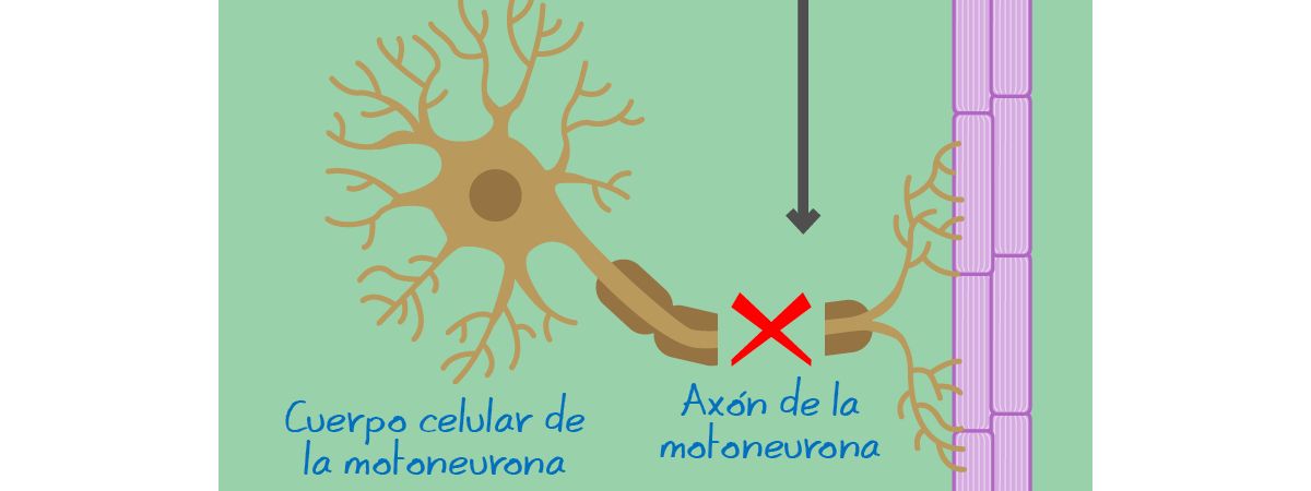 Atrofia Muscular Espinal: ¿Qué es? | Roche Pacientes