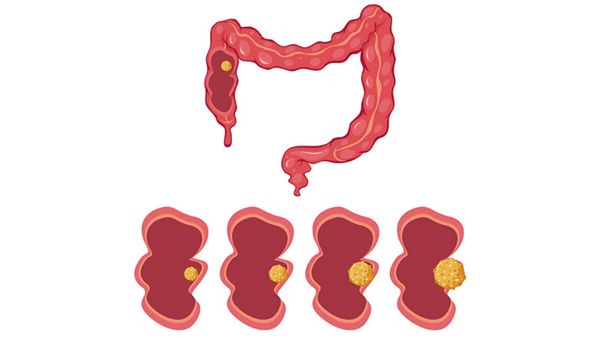 Estadios del Cáncer de Colon | Roche Pacientes