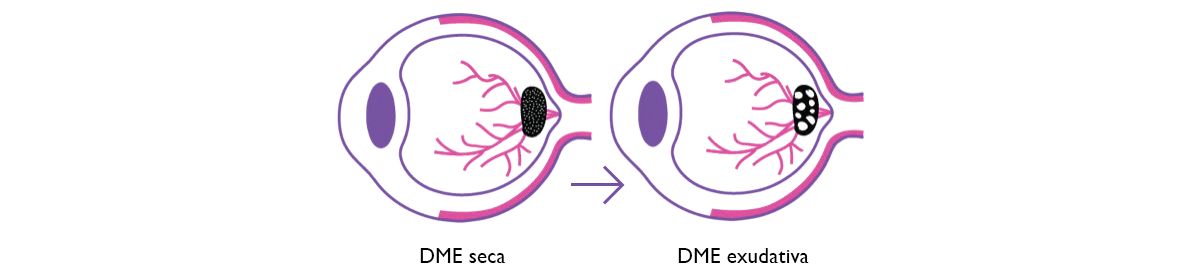Degeneración Macular Asociada a la Edad (DMAE) | Roche Pacientes