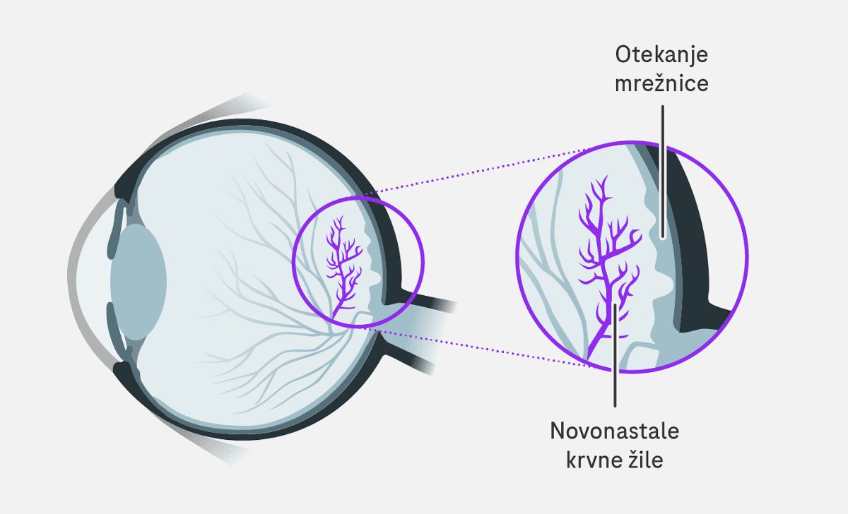 Starostna degeneracija makule | Roche za zdravje